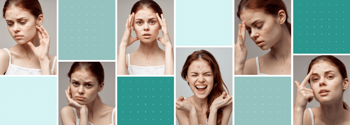 Teen skincare: How do I control my oily skin and prevent pimples ...