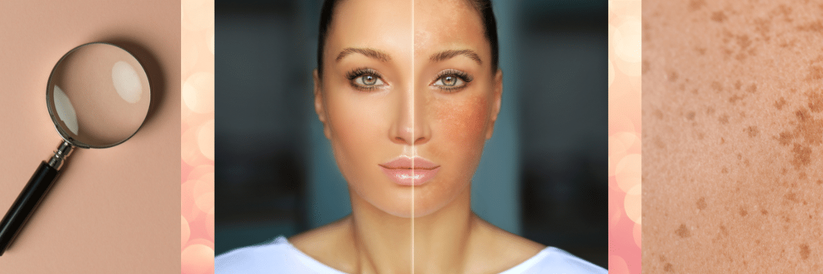 All about skin pigmentation - Gaia Day Spa